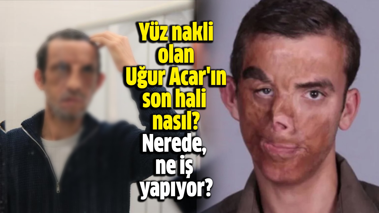 Yüz nakli olan Uğur Acar'ın son hali nasıl, nerede, ne iş yapıyor ...